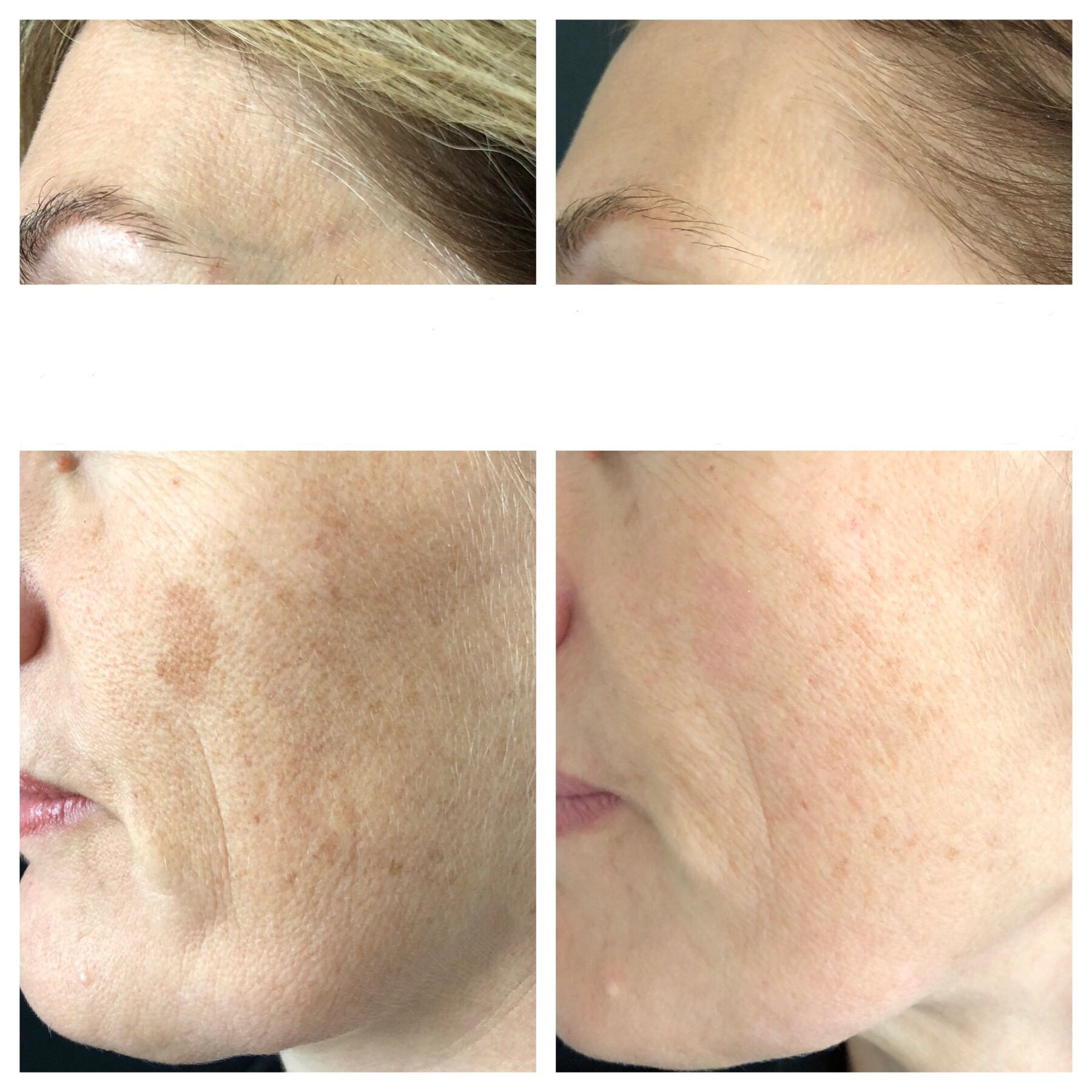 Pigmentflecken entfernen / lasern in Zürich | rivr.ch